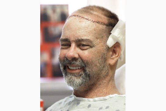 Texas Surgeons Perform Historic Skull and Scalp Transplant - ODT