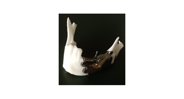 Robotic Laser Bone-Cutting Technology Approved in Europe | ODT