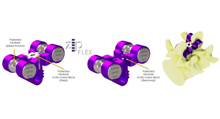 Aurora Spine Granted Patent for Interlaminar Single Implant Tech - ODT