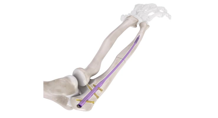 Conventus Flower Orthopedics’ Flex-Thread Ulna Intramedullary Nail ...