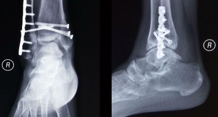 'Close Contact Casting' Could Help Elderly Patients with Unstable Ankle ...