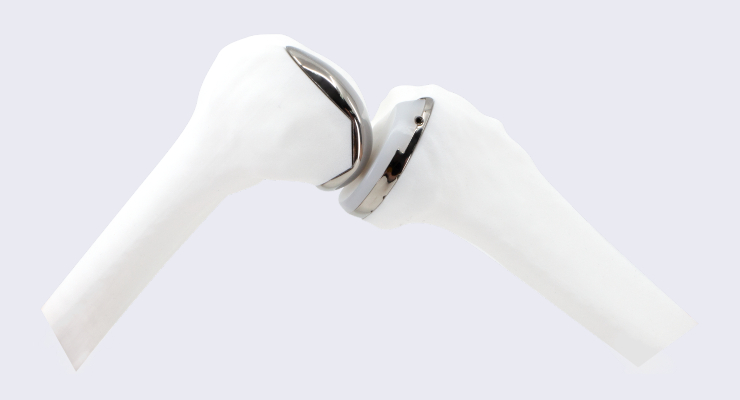 Bodycad Announces First Use of BC Relfex Uni in Patients - ODT