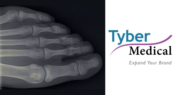 FDA Clears Tyber Medical's All-in-One Extremity Joint Fixation Device - ODT