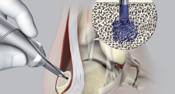 Stryker Unveils Ultrasonic Bioresorbable Implant for Suture and Tissue ...