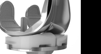 From AAOS: ConforMIS Rolls Out its Latest Patient-Specific Knee Implant ...