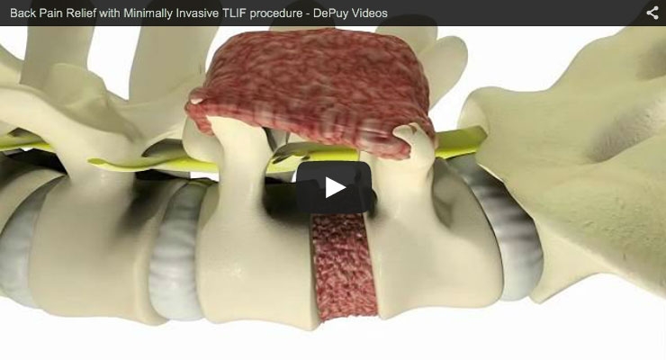 Back Pain Relief with Minimally Invasive TLIF procedure - ODT