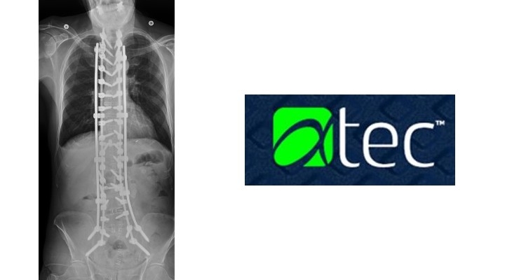 Alphatec Launches InVictus MIS and Open Spinal Fixation Systems - ODT