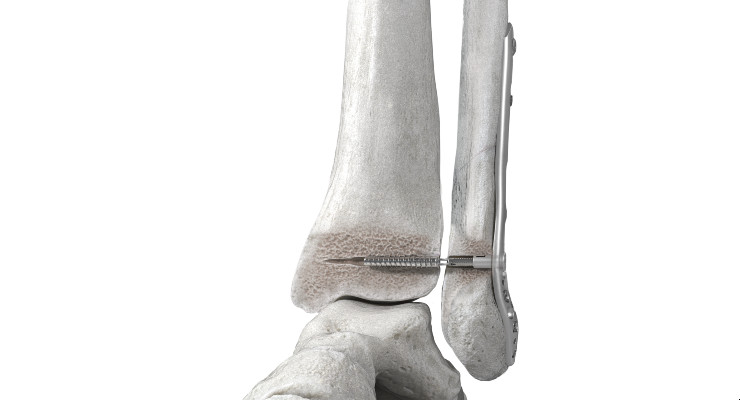 DePuy Synthes Launches FIBULINK Syndesmosis Repair System - ODT