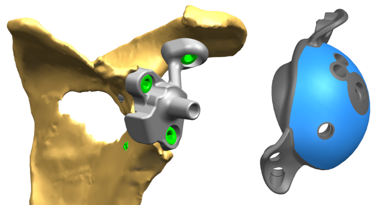 LimaCorporate, HSS's 3D-Printed, Patient-Specific Implants Used in ...