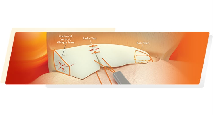 Ceterix Orthopaedics Awarded Patent for Transosteal Anchoring Methods ...