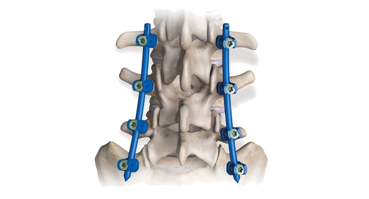 Giving Back: An Examination of the Spine Technologies Sector - ODT