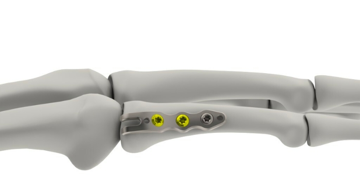 Tyber Wins FDA Nod for Mini-Frag System Line Extension - ODT