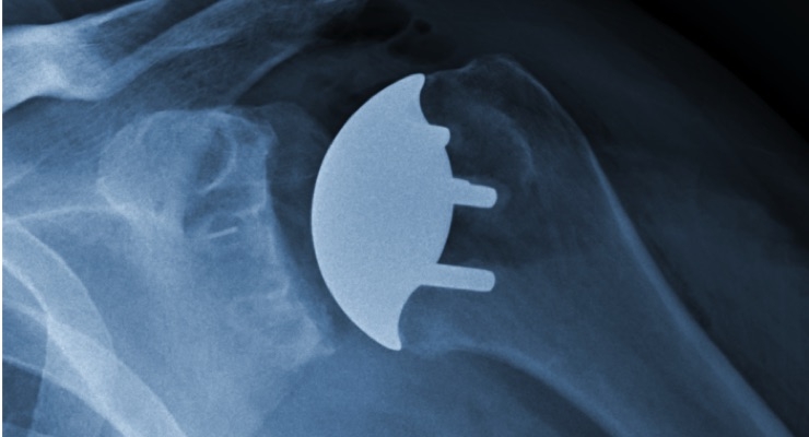 Additional U.S. Patents Issued to Catalyst OrthoScience for Stemless ...