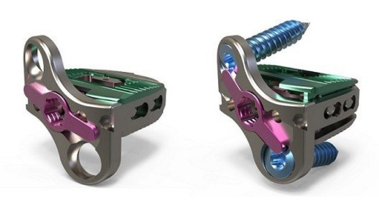 Atlas Spine Launches Expandable Cervical Stand-Alone Interbody System - ODT