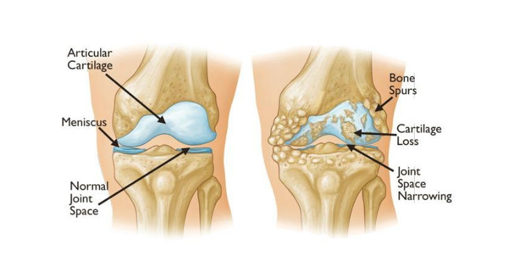 New Research Ranks the Effectiveness of Nonsurgical Treatments for Knee ...