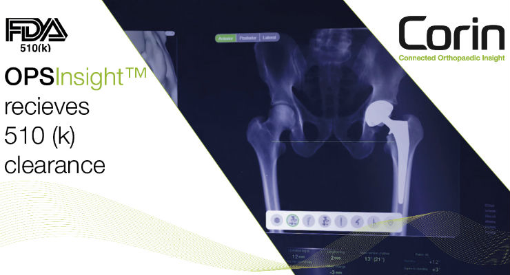 Corin's OPSInsight Receives 510(k) Clearance for Use in THA - ODT