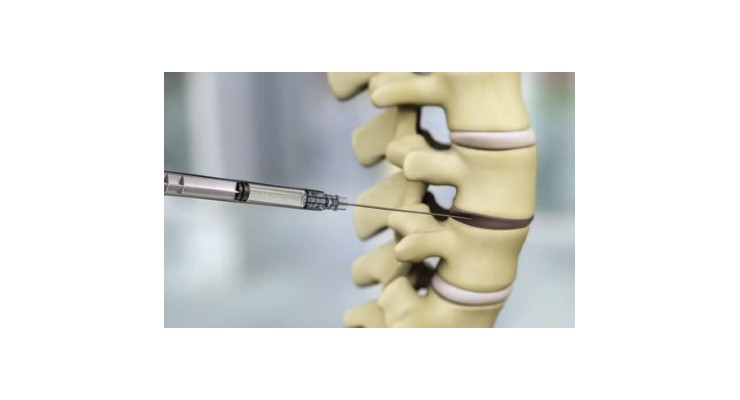 DiscGenics Touts Positive Clinical Data for DDD Cell Therapy - ODT