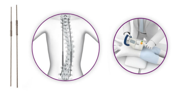 NuVasive Launches MAGEC X for Early Onset Scoliosis Treatment in the UK ...