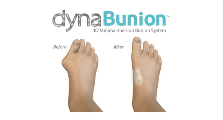 CrossRoads Extremity Systems Launches DynaBunion Lapidus System - ODT