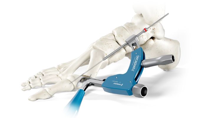 Enovis to Acquire Novastep to Grow Position in Foot & Ankle - ODT