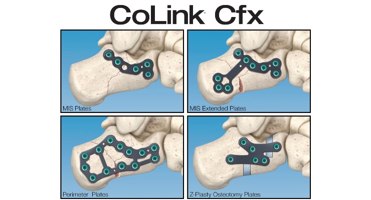 In2Bones Introduces CoLink Cfx Calcaneal Fixation System - ODT