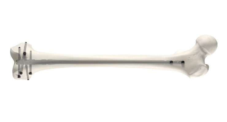 Stryker Releases T2 Alpha Femur Retrograde Nailing System - ODT