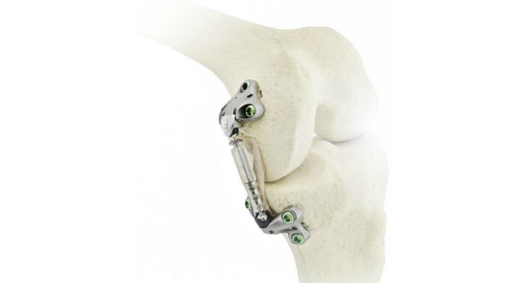 First U.S. Patient Treated with Moximed's Atlas System for ...