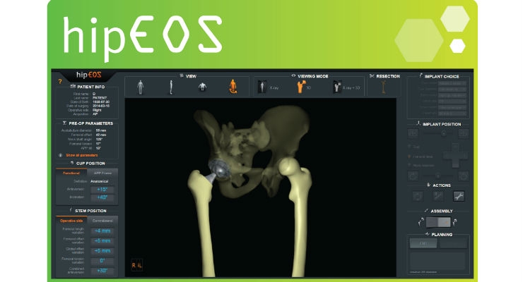 FDA Clears EOS imaging's hipEOS 3.0 Surgical Planning Software - ODT