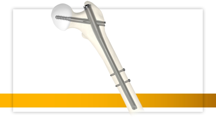 Stryker Augments Gamma4 Hip Fracture Nailing System - ODT