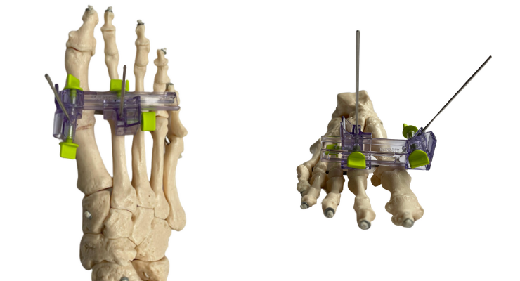 RELJA Innovations Releases New Bunion Reduction Clamp - ODT