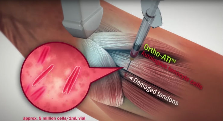 Orthocell Granted European Tendon Regeneration Patent - ODT