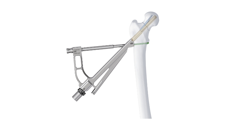 DePuy Synthes Launches Implant Solution for Femoral Neck Fixation - ODT