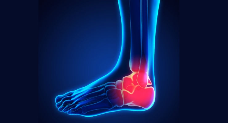 3D Printing Offers Patients ‘Life-Changing’ Option for Talus ...