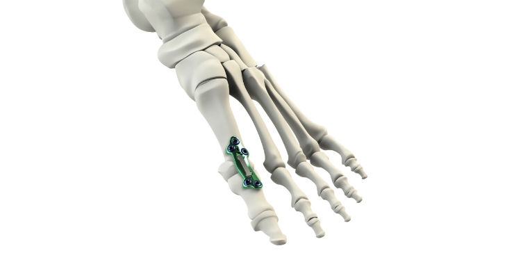 CrossRoads Extremity Systems Launches Active Stabilization MPJ Implant ...