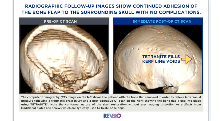 NIH Awards RevBio $2.4M Grant for Regenerative Bone Adhesive Trial - ODT