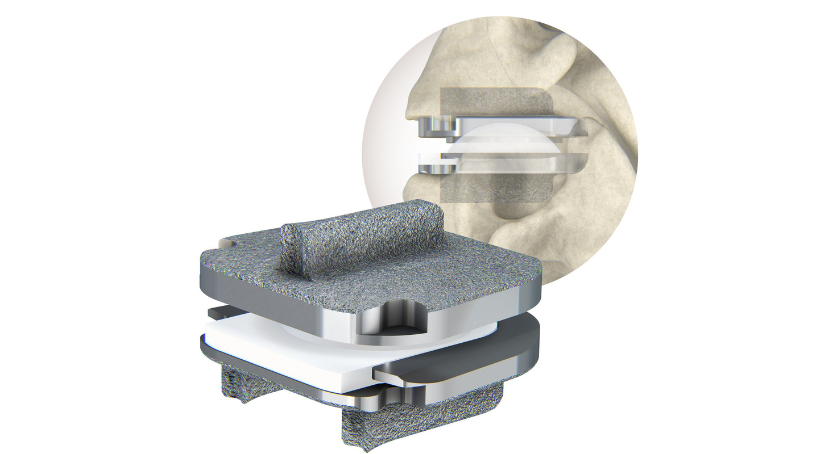 Centinel Spine's prodisc C Nova Makes its U.S. Surgical Debut - ODT