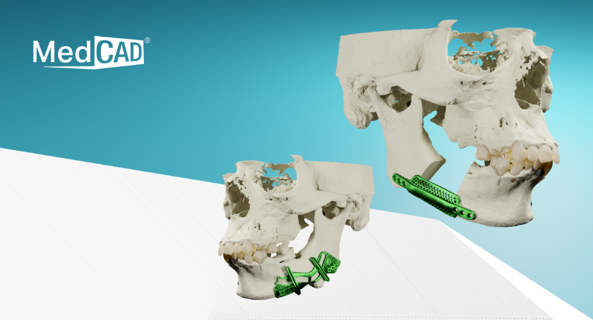 MedCAD Introduces New 3D-Printed AccuPlate Product - ODT