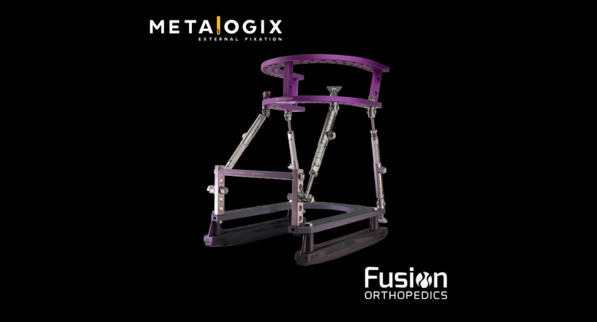 Fusion Orthopedics Enhances its Foot & Ankle Portfolio - ODT