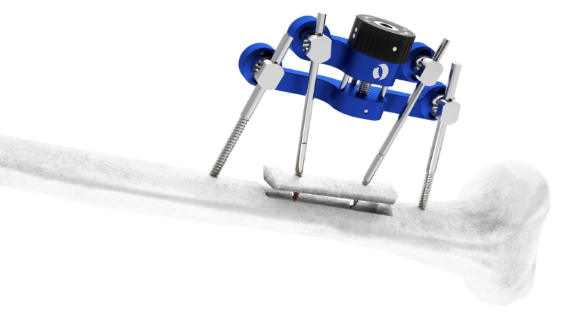 Orthofix Earns FDA, EU Nods for Transverse Bone Transport System