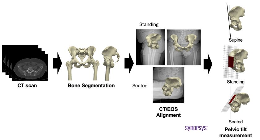 A Bimodal Imaging Workflow for Functional Spino-Pelvic Assessment - ODT