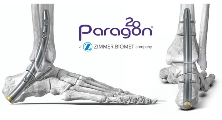 Orthopedic Extremity Implants Are Precision in Miniature
